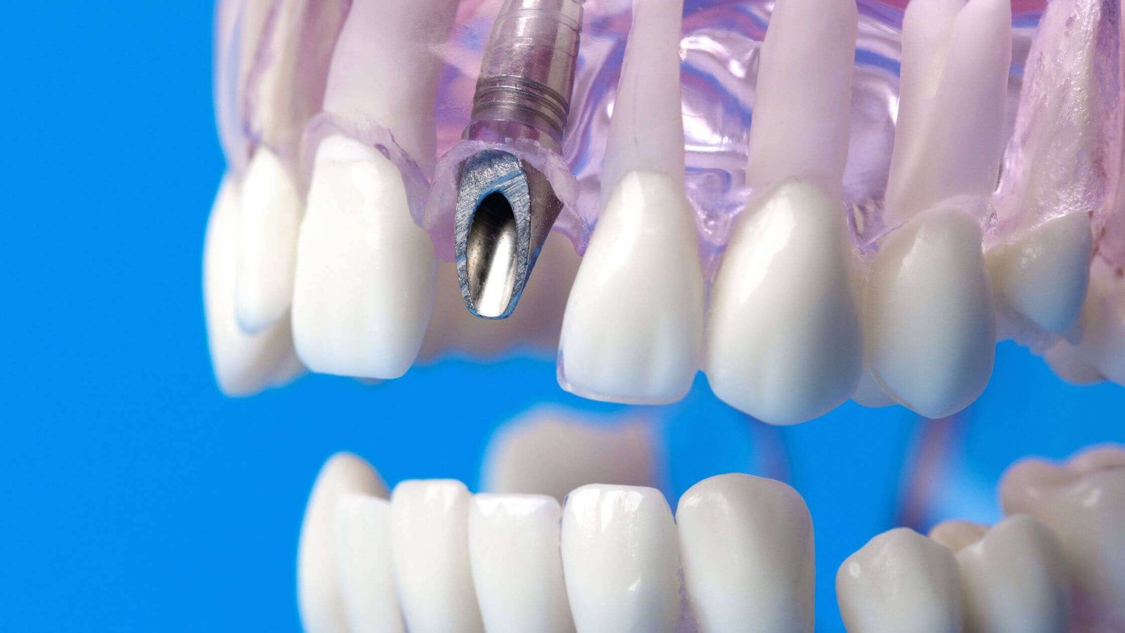 Screw-In Dentures: Exploring Costs of Dental Implant Options