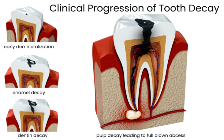 How to Identify Small Cavities Early: 7 Signs to Watch
