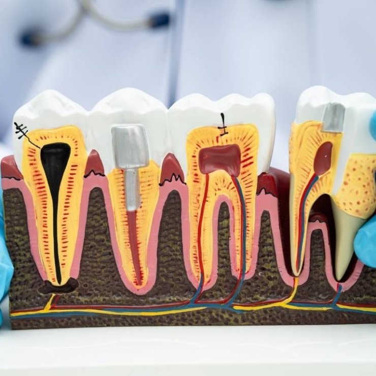 Pulpotomy and Pulpectomy: Tooth Pulp Treatment Explained